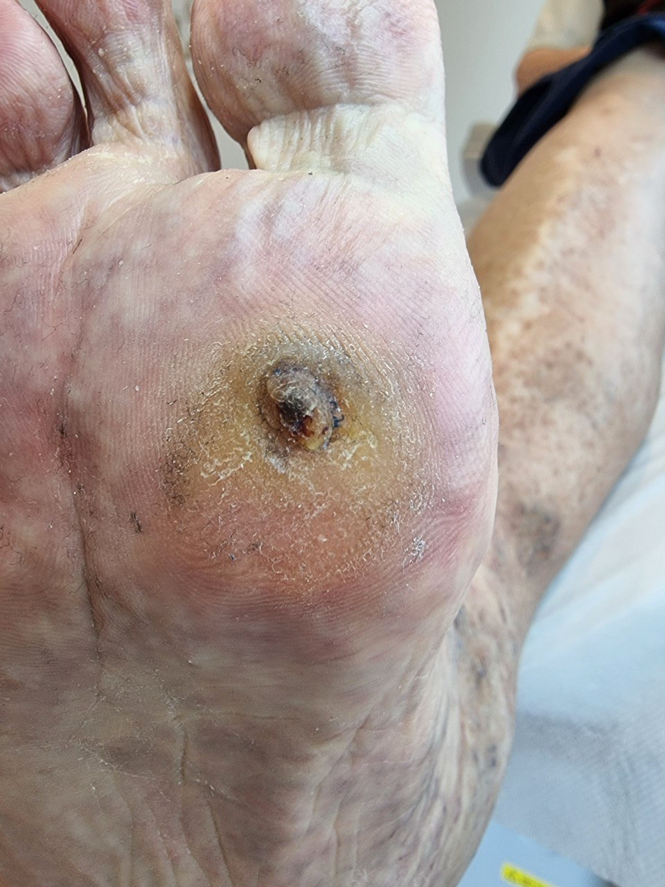 Nuospaudų šalinimas Vilnius – Podologijos Klinika Vilniuje