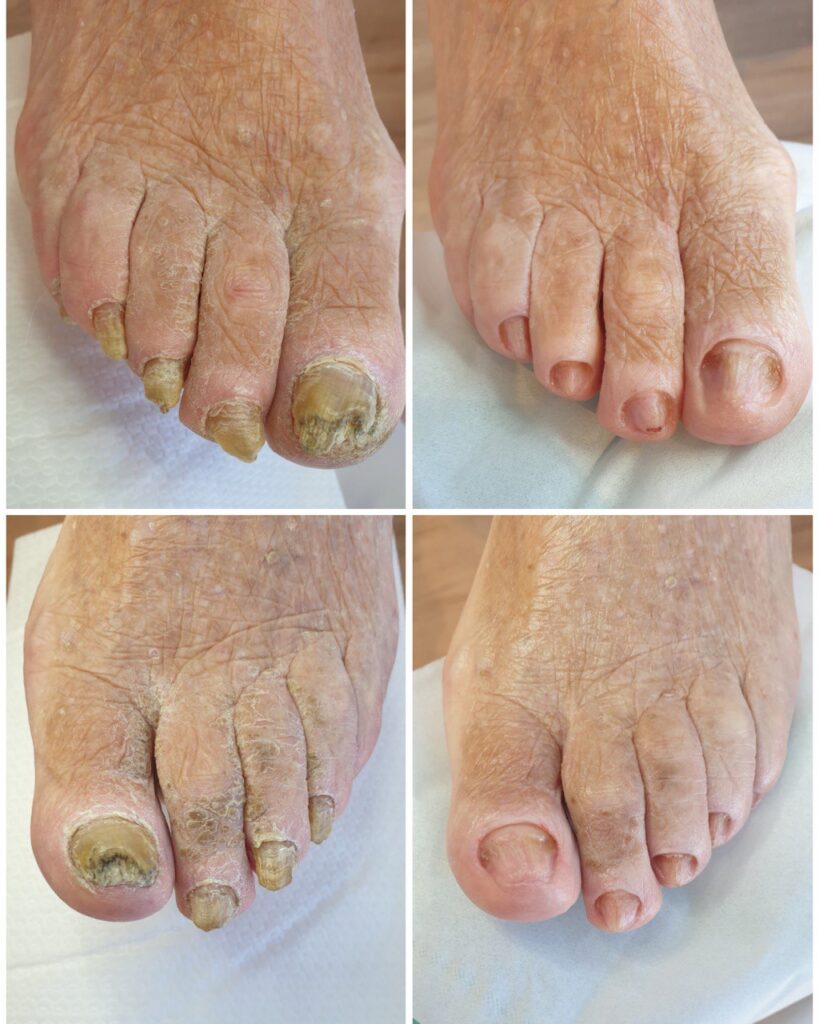 Kaip atrodo diabetinė pėda: simptomai ir svarbūs požymiai